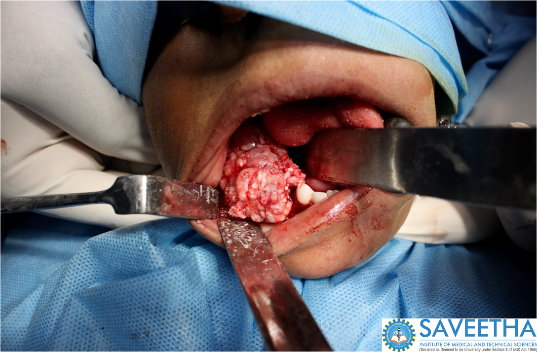 “SAVEETHA’S SURGICAL AND PATHOLOGICAL EXCELLENCE IN UNMASKING 526 TEETH ...