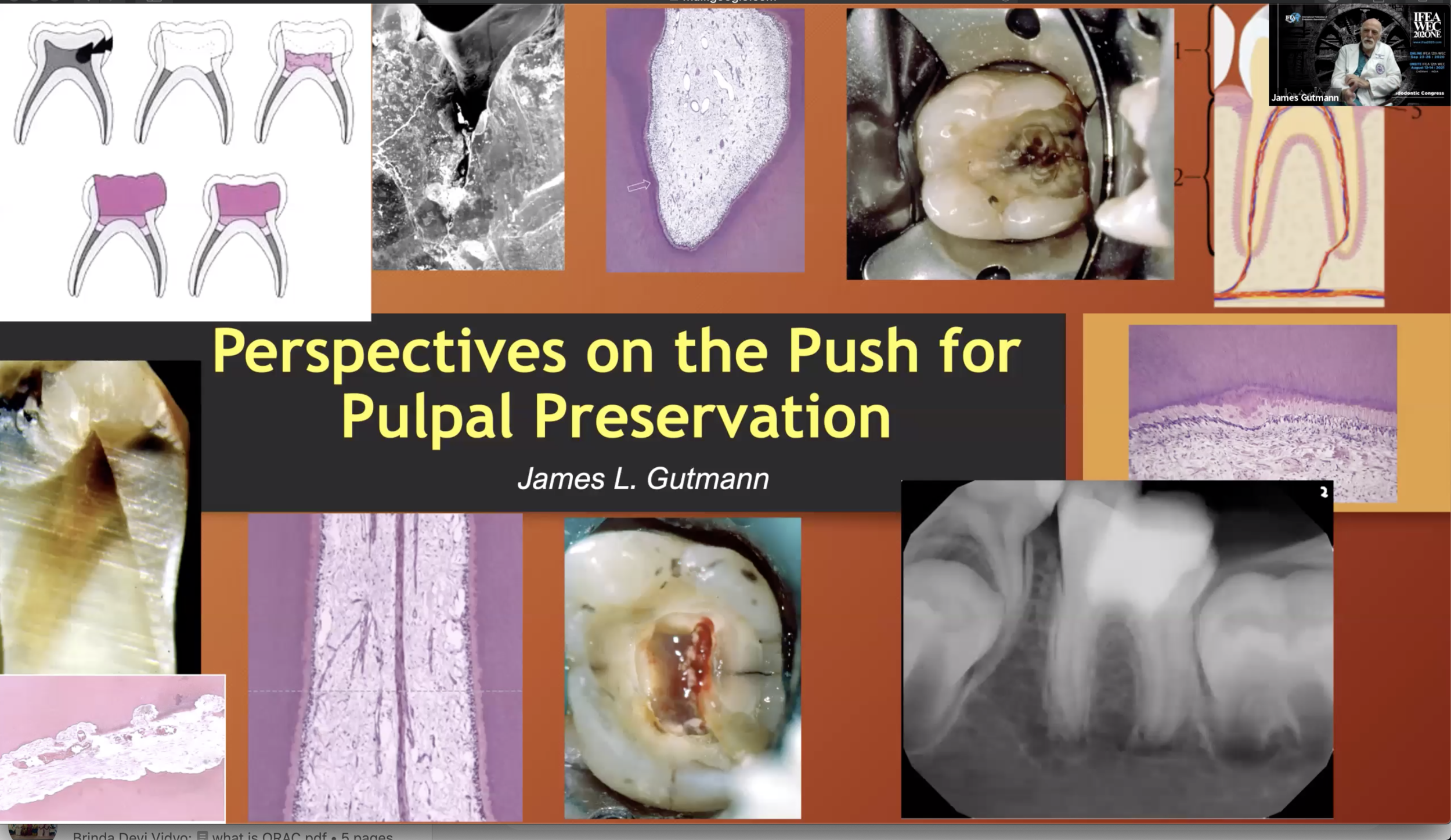 Webinar: Perspectives on the Push for Pulpal Preservation — dentistry ...