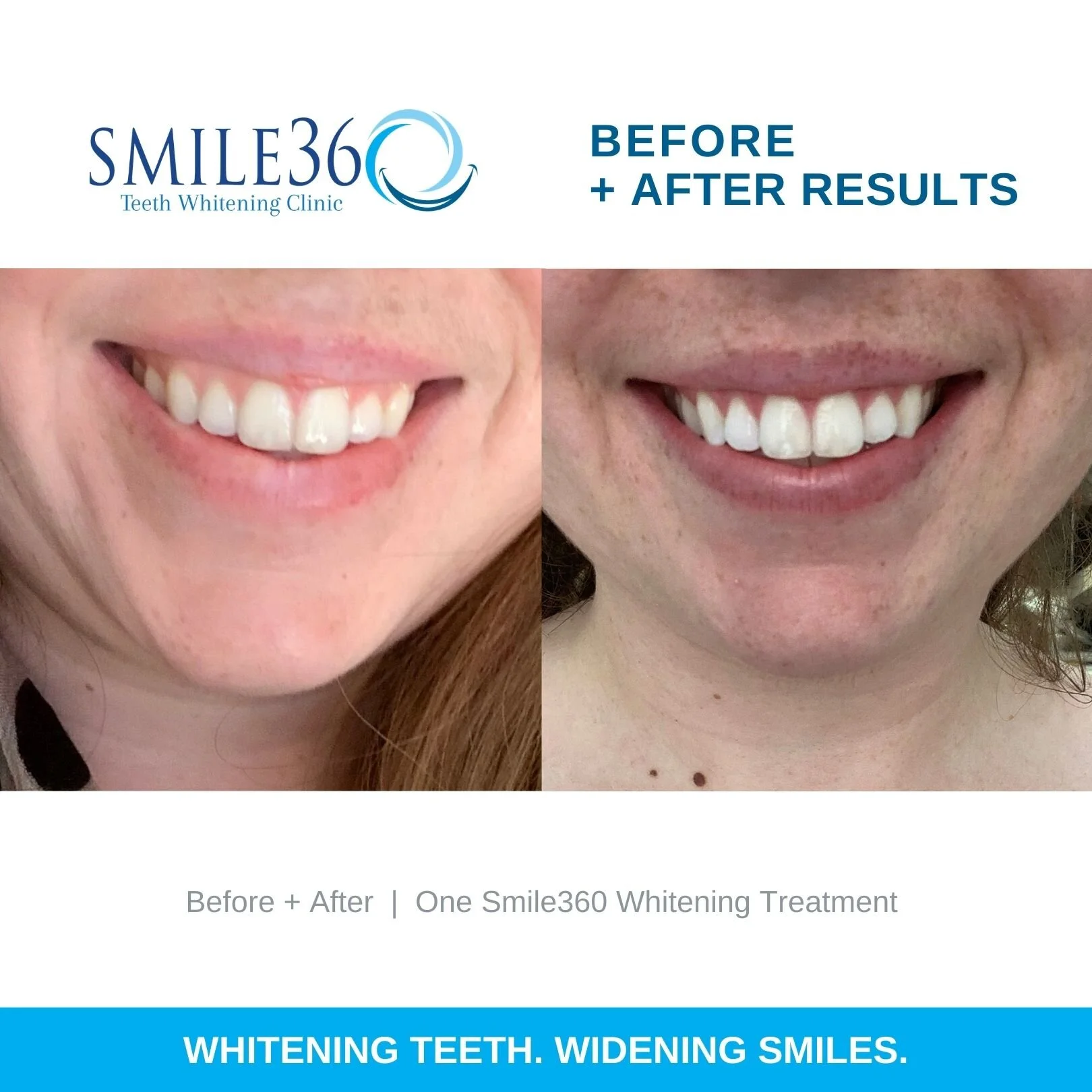 Smile360 Teeth Whitening | Canada Teeth Whitening Supplies, Equipment + Gel