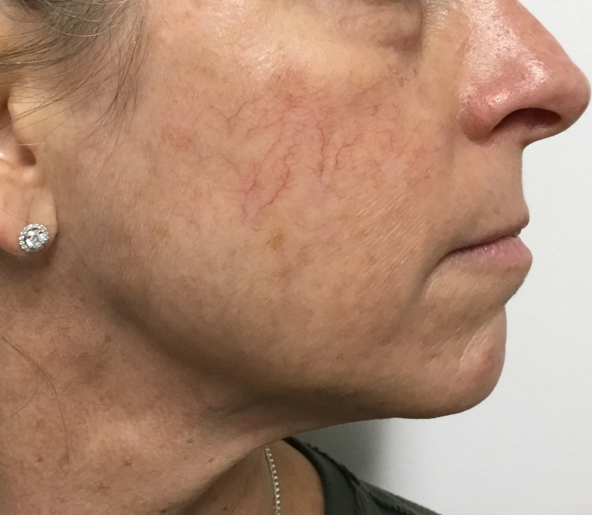 Results — IndyDerm