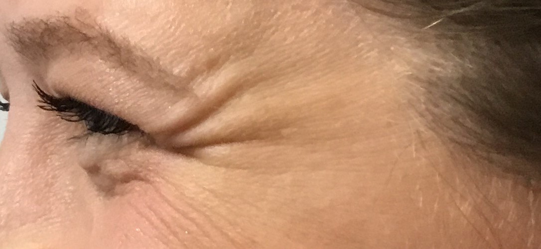 Results — IndyDerm