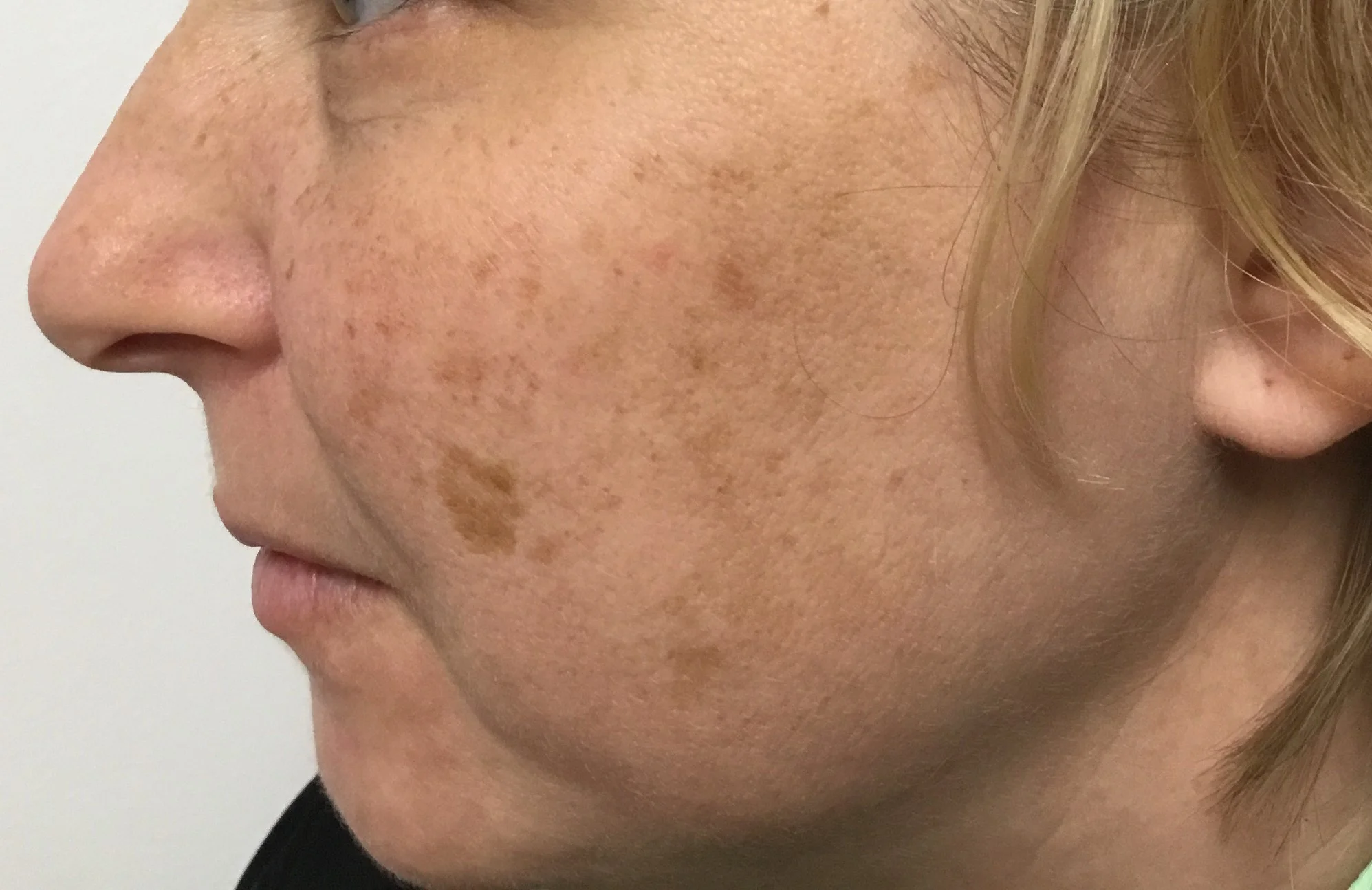 Results — IndyDerm