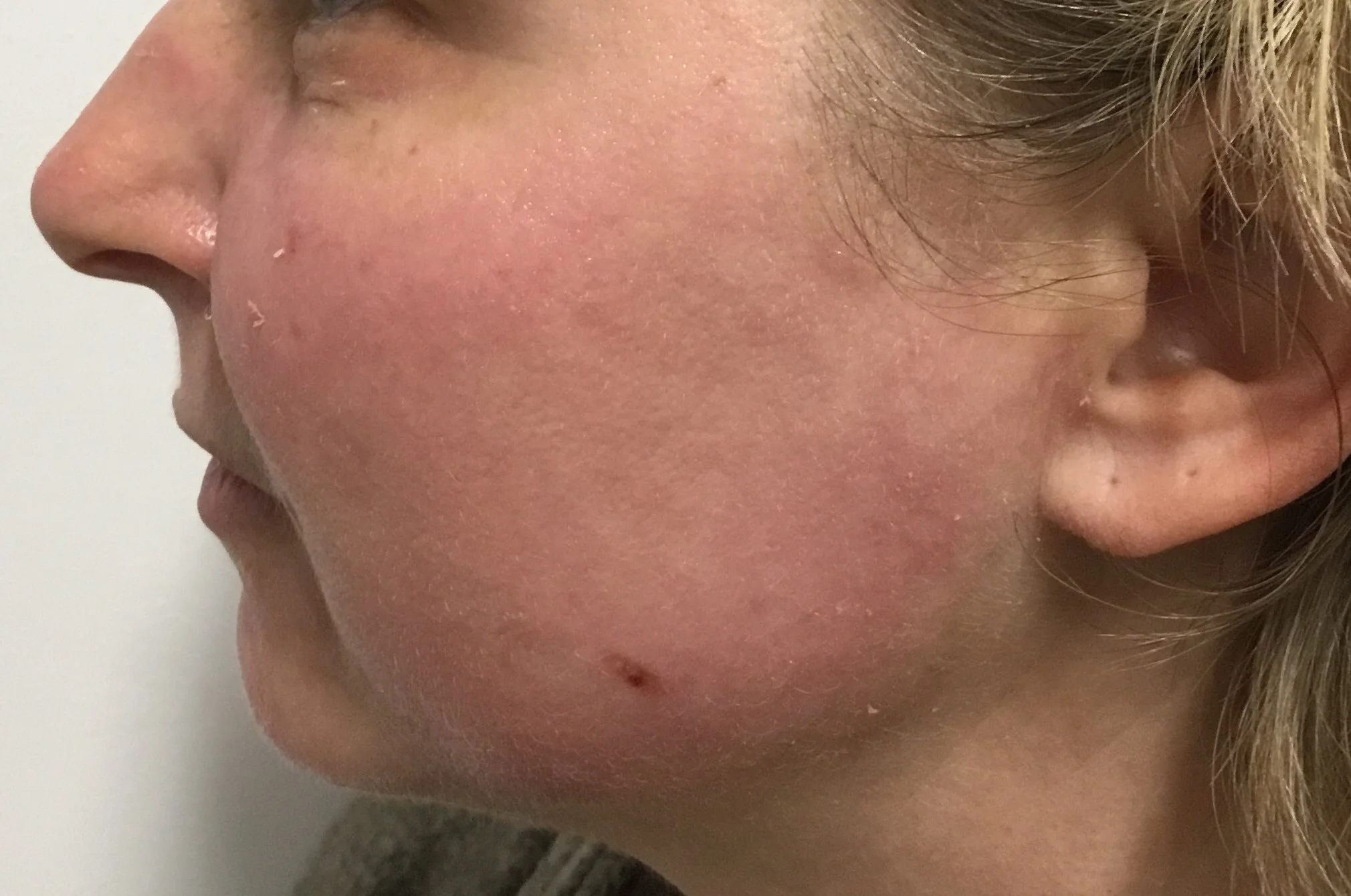 Results — IndyDerm