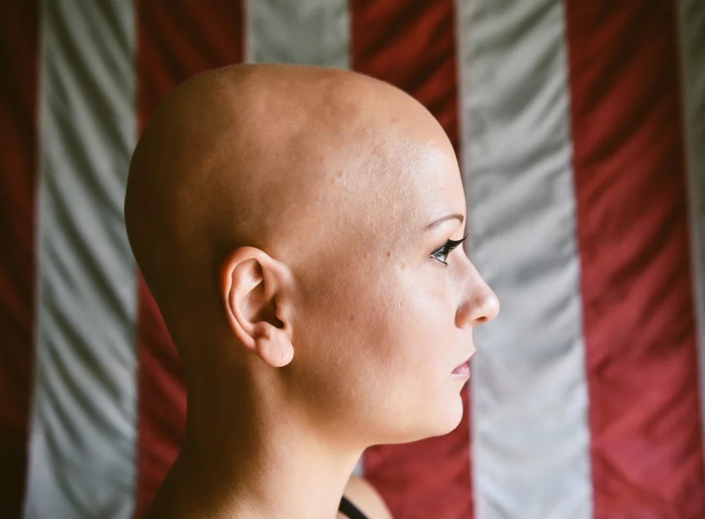 Alopecia Universalis Woman