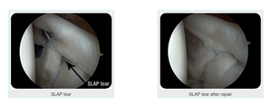 SLAP Tears | Orthopaedic surgery of the shoulder