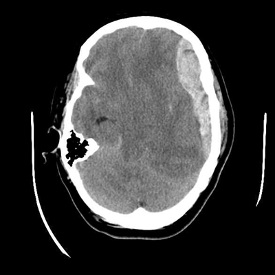 Blood Can Be Very Bad! - How to Read an Emergent Head CT — Downeast ...