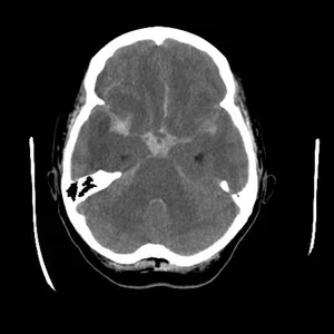 Blood Can Be Very Bad! - How to Read an Emergent Head CT — Downeast ...