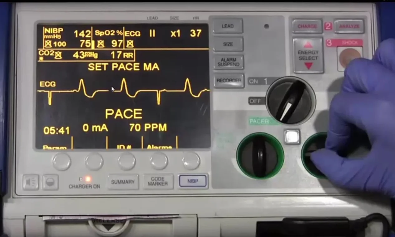 Transcutaneous Pacing — Downeast Emergency Medicine