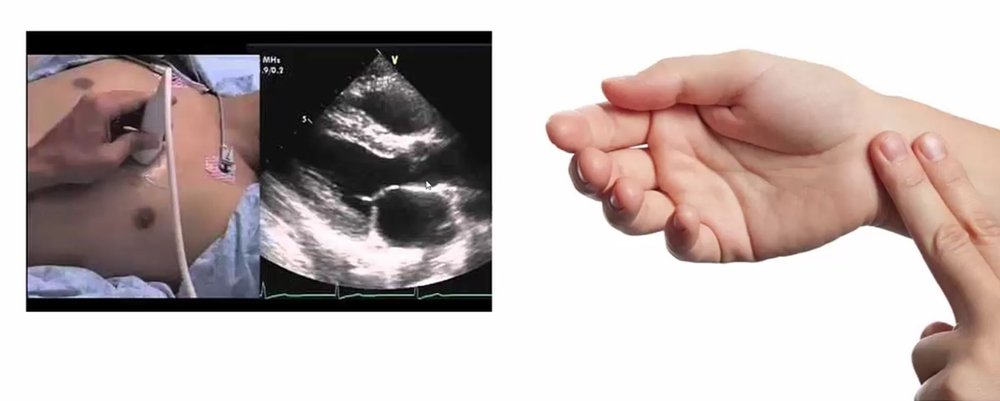 Transcutaneous Pacing — Downeast Emergency Medicine