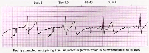 Transcutaneous Pacing — Downeast Emergency Medicine