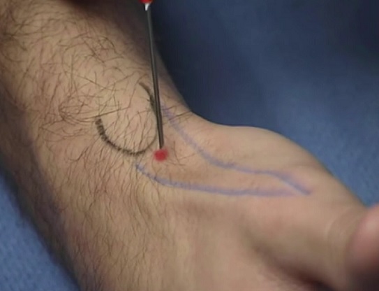 Nerve Blocks of the Hand and Wrist — Downeast Emergency Medicine