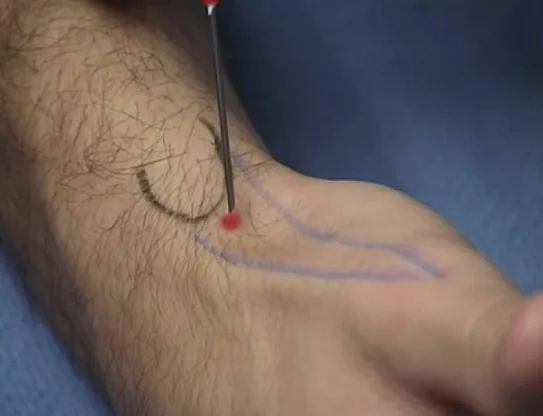 Nerve Blocks of the Hand and Wrist — Downeast Emergency Medicine