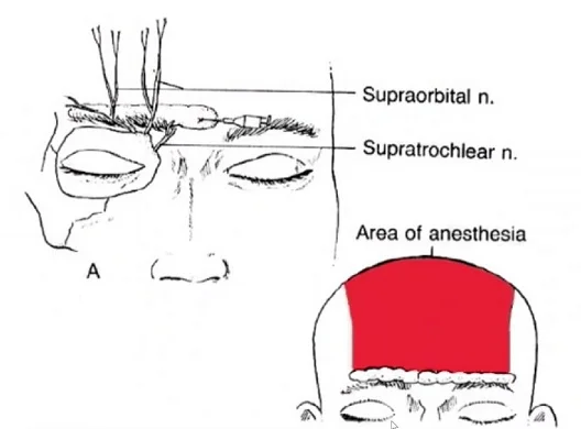 Nerve Blocks of the Face and Mouth — Downeast Emergency Medicine