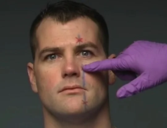 Nerve Blocks of the Face and Mouth — Downeast Emergency Medicine