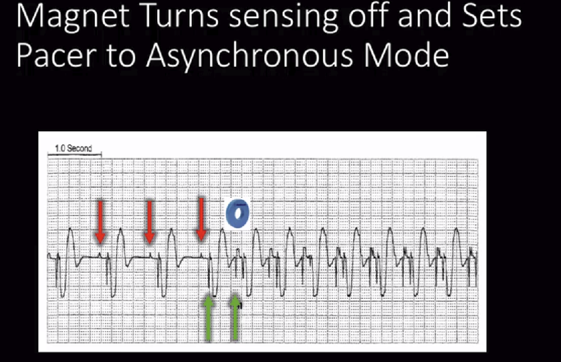 What the Heck is Going on with this Pacemaker?! — Downeast Emergency ...