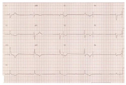 What the Heck is Going on with this Pacemaker?! — Downeast Emergency ...