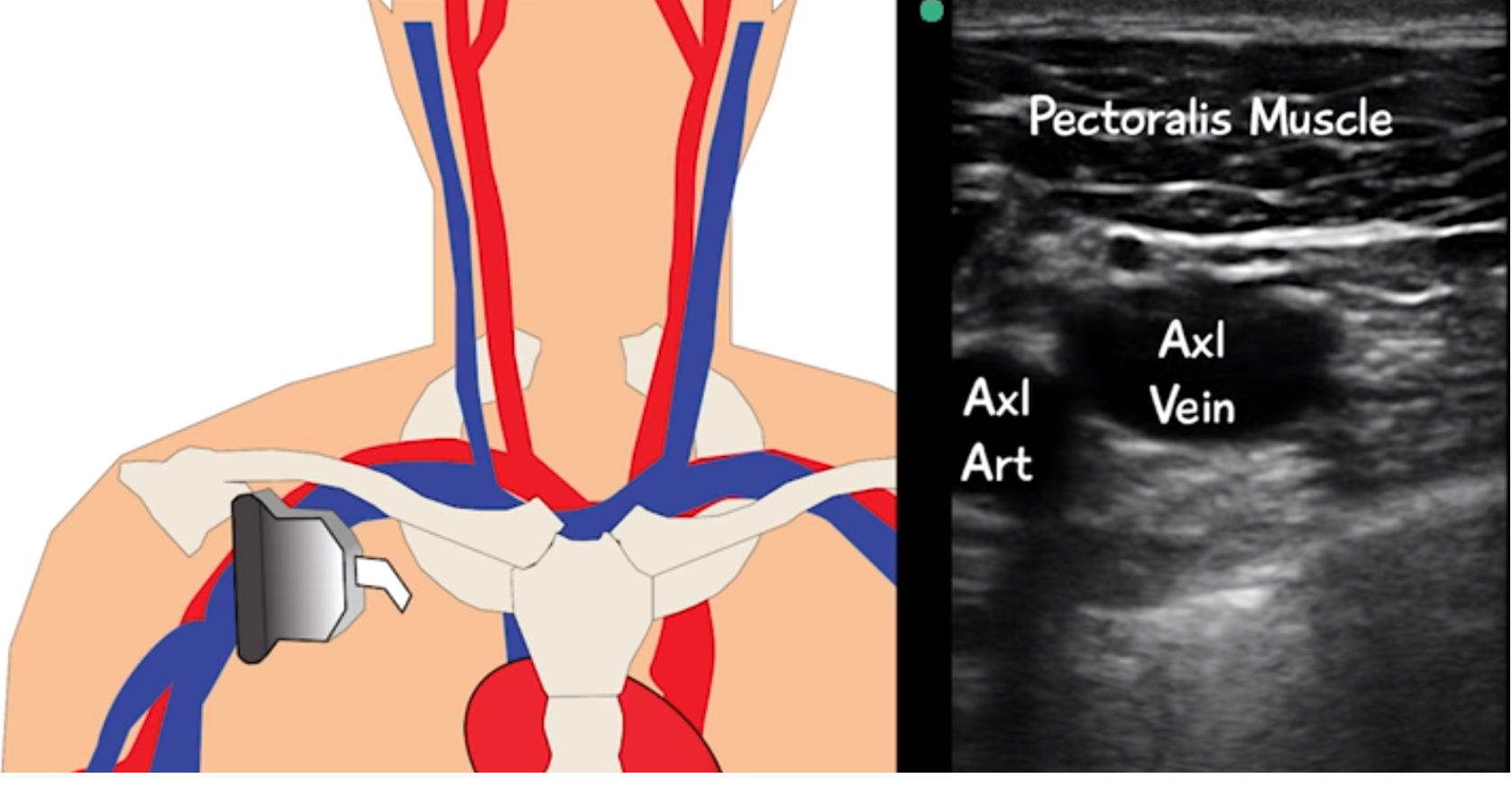 The Subclavian Line: The Resuscitation Line of Champions — Downeast ...