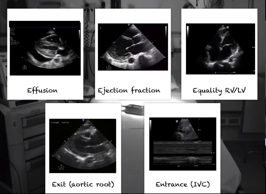 Echo Extravaganza Part 3: The 5 E’s of Echocardiography — Downeast ...