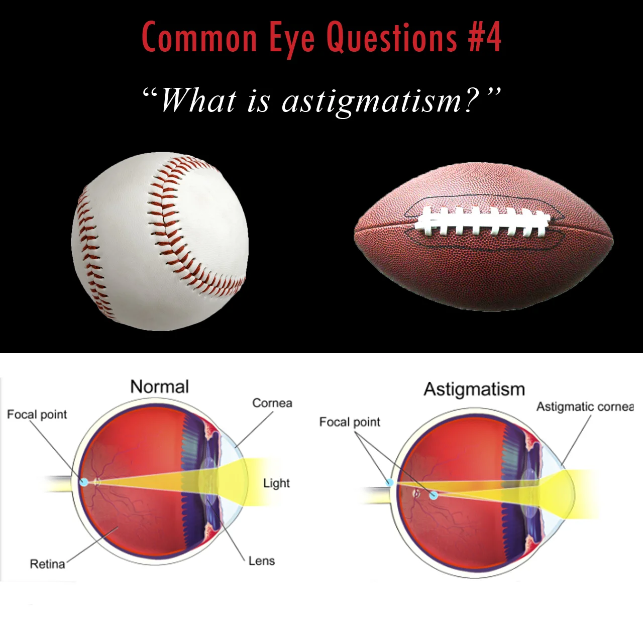 What Is Astigmatism Matt Weed MD Spokane Pediatric Ophthalmologist