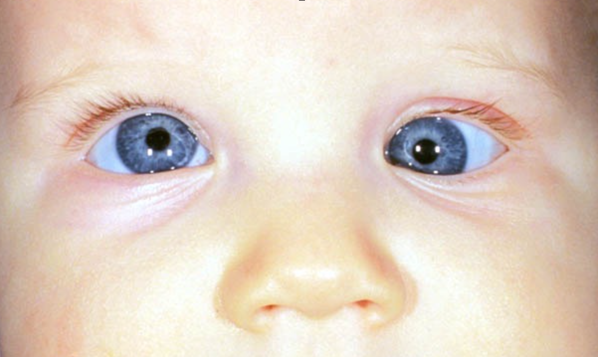 Common Eye Questions — Eye Blog — Matt Weed, MD Spokane Pediatric ...