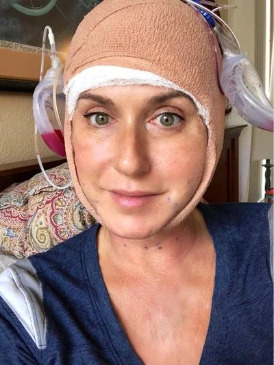 Neck Lift Recovery Day By Day — HZ Plastic Surgery