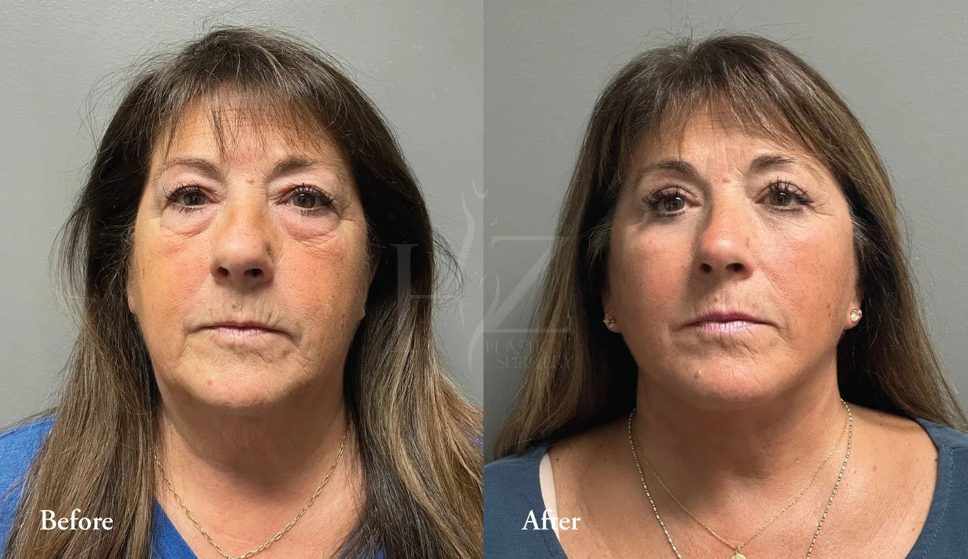 Facelift Before & After — HZ Plastic Surgery