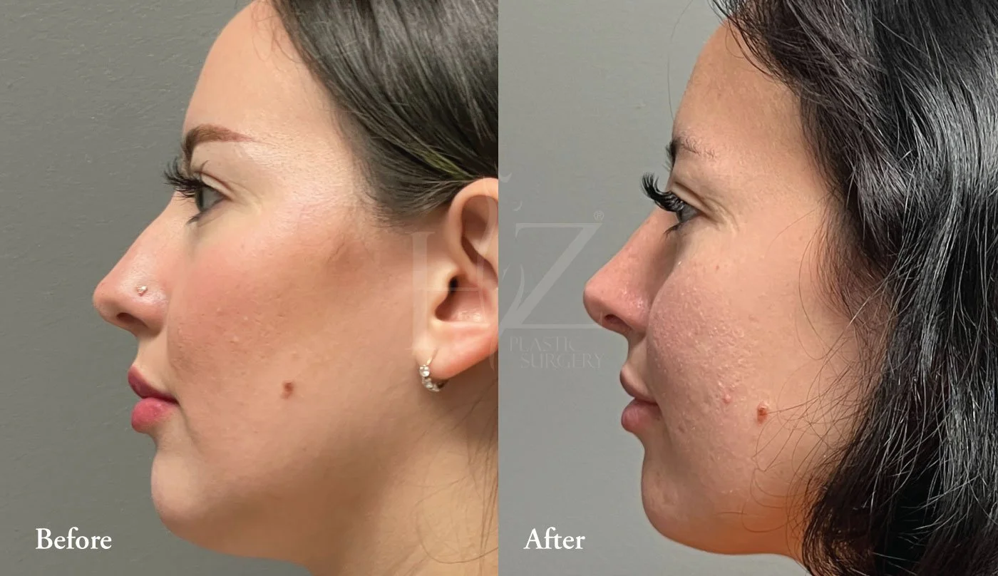 Rhinoplasty Recovery Day 7