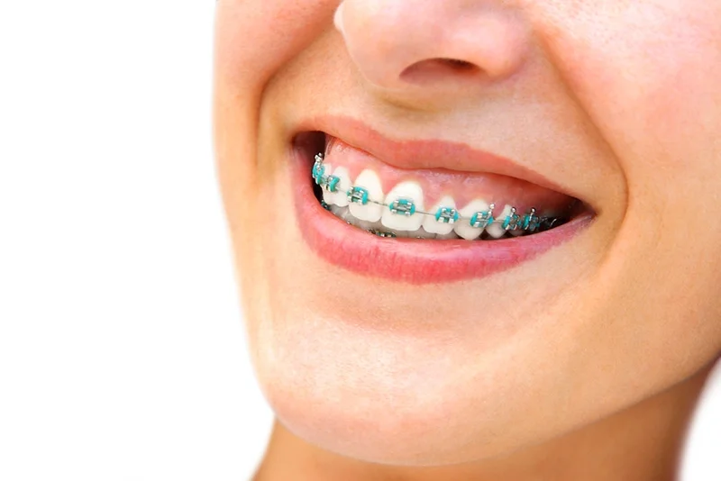 Visit Dunedin Orthodontics today and learn about how you can straighten ...
