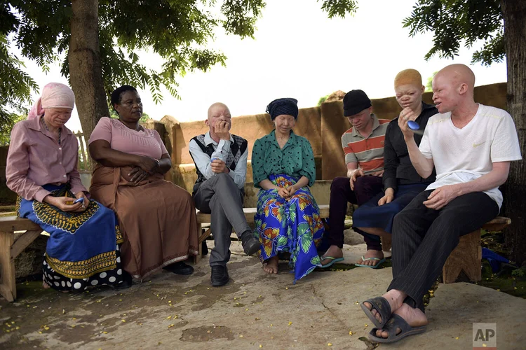 People with albinism issued with protective alarms in Malawi — AP Photos