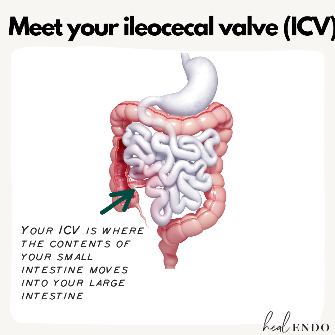 What is Endo Belly Series: Ileocecal valve pain — Heal Endo