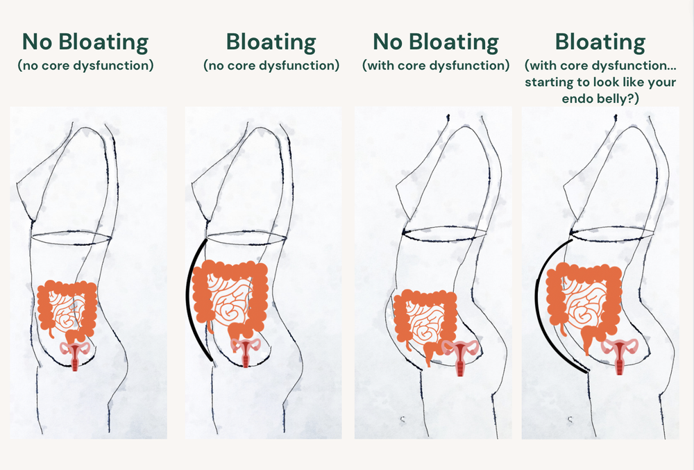 Blog - the 6 main culprits of Endo Belly — Heal Endo