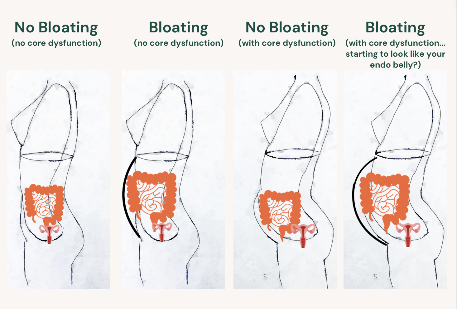 Blog - the 6 main culprits of Endo Belly — Heal Endo