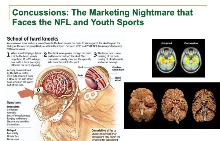 Concussions in American Football by Austin Link and Dr. Thomas Orr ...
