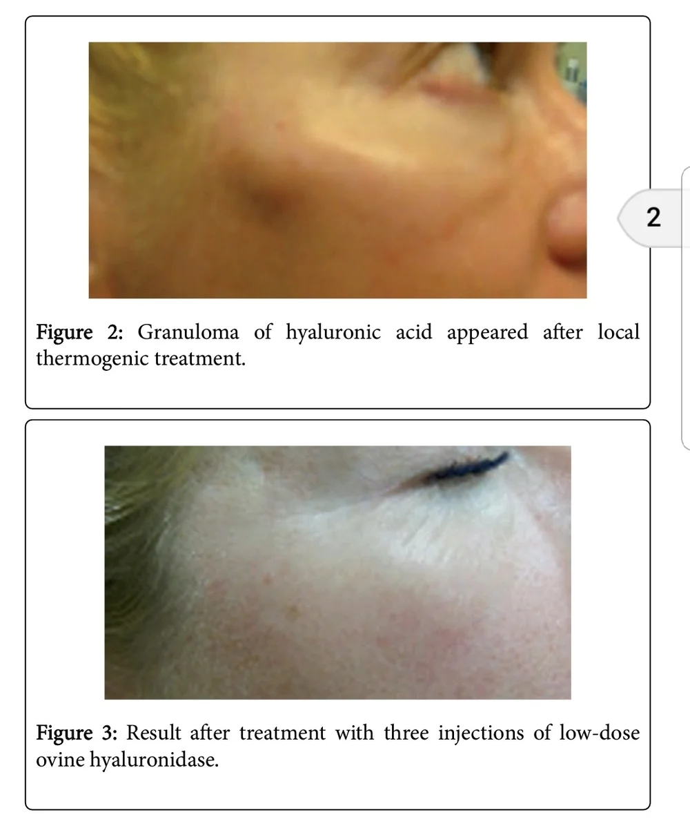 Tyndall Effect Skin