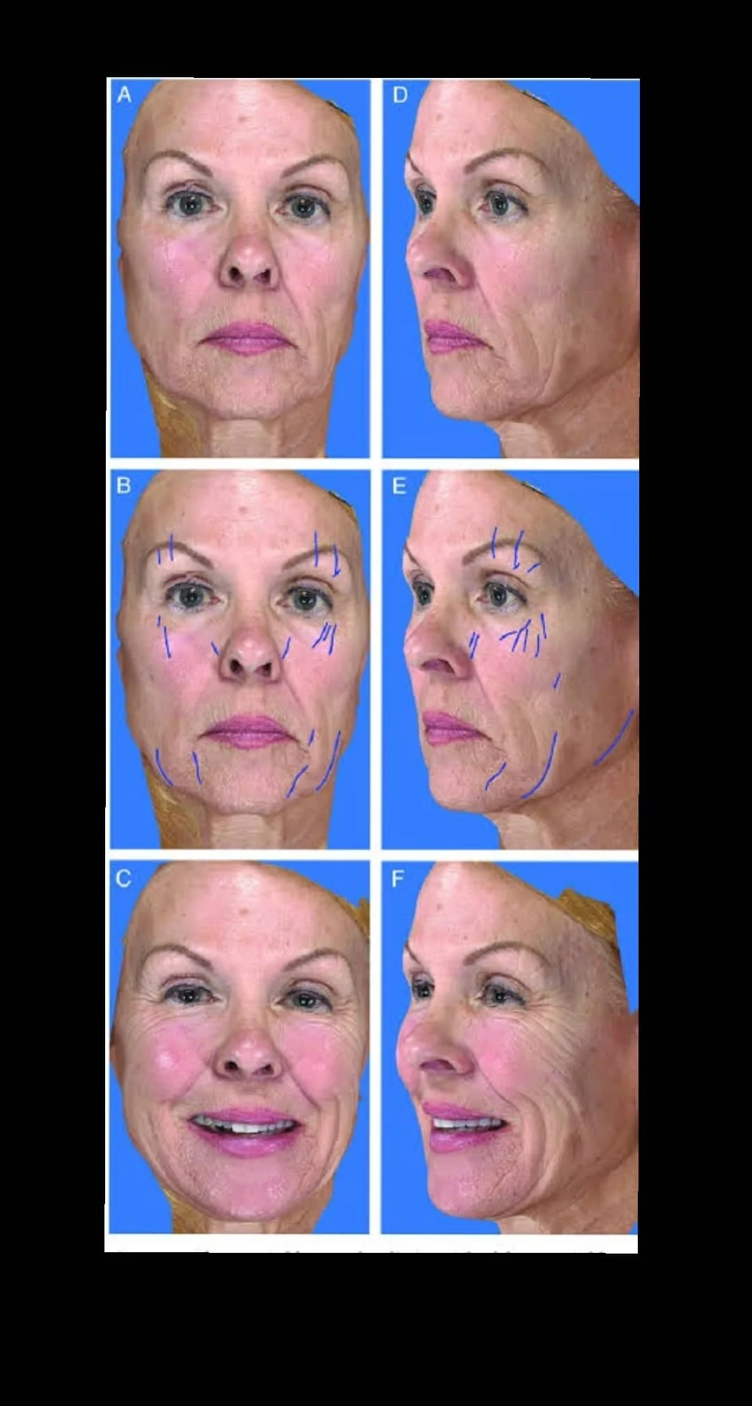 Sleep Wrinkles | JUVERNE