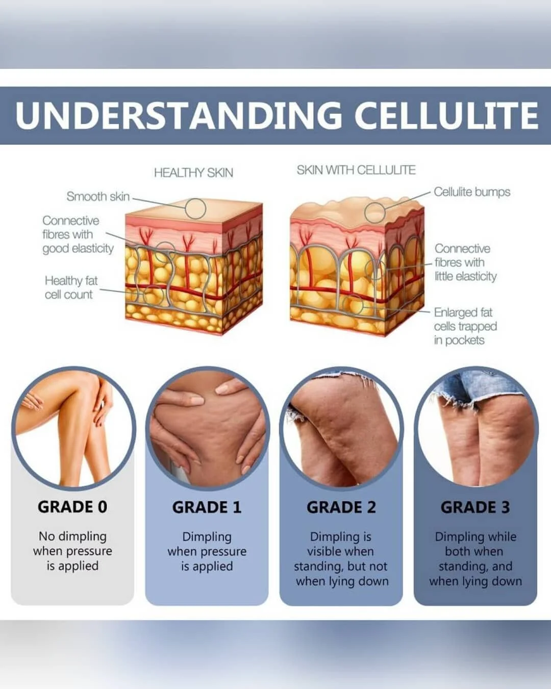 CELLULITE JUVERNE