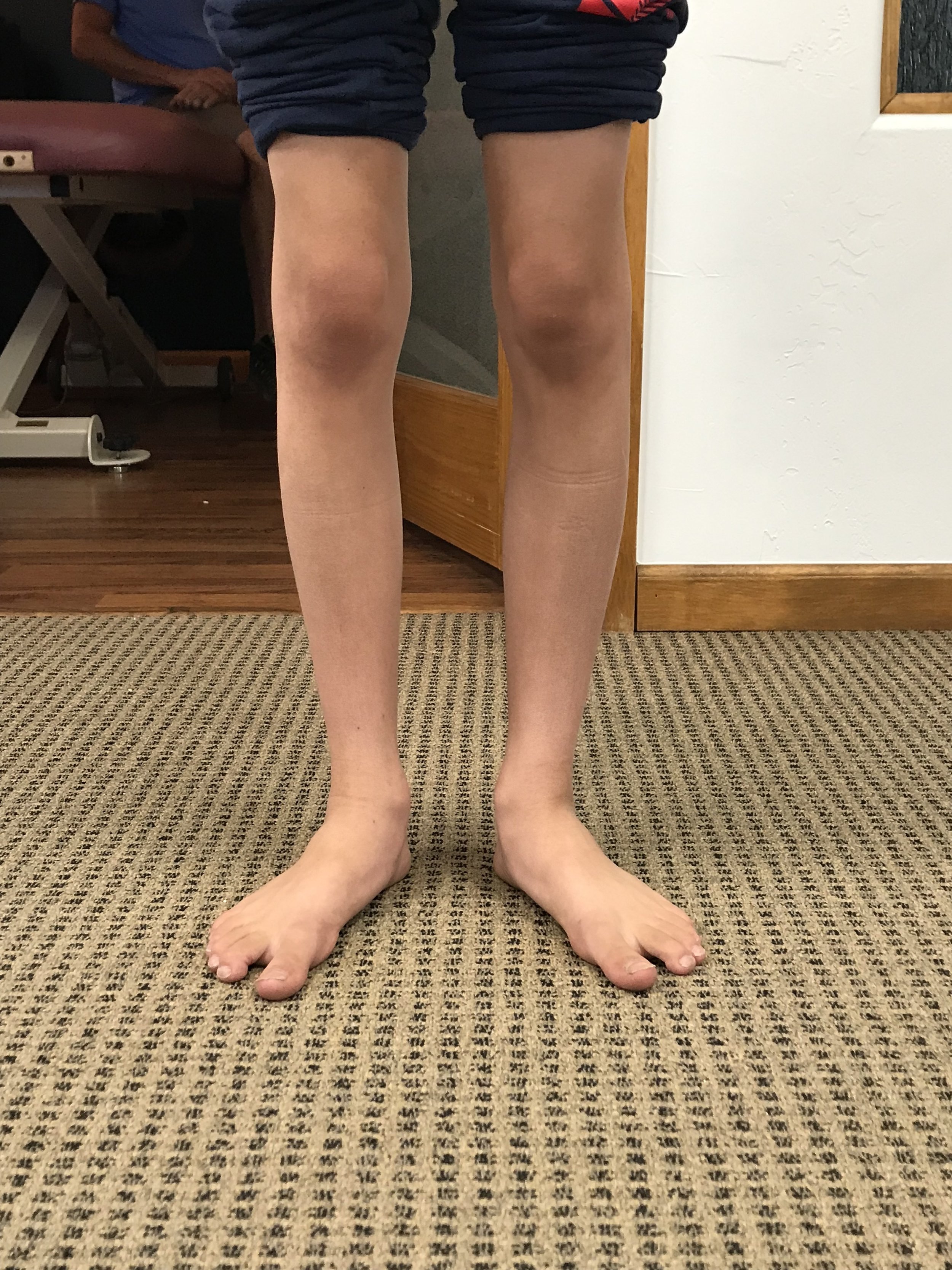 External tibial torsion or femoral retrotorsion? — The Gait Guys