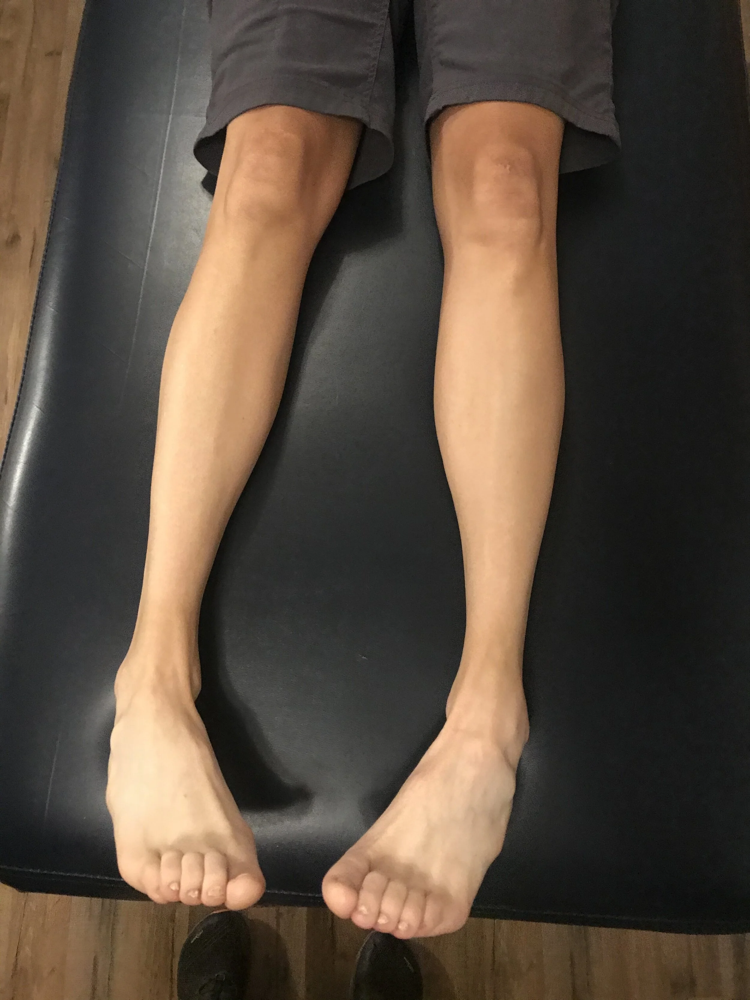 Curly toes? — The Gait Guys