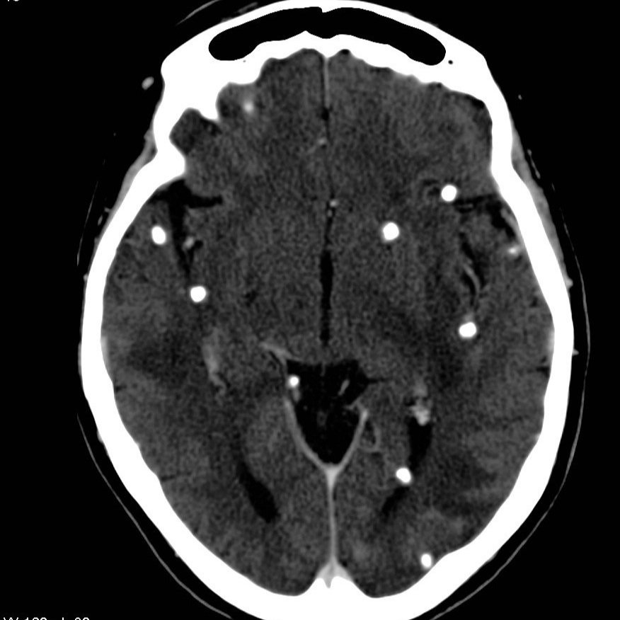 Should You Be Afraid of Brain Worms? — Insight Neuropsychology