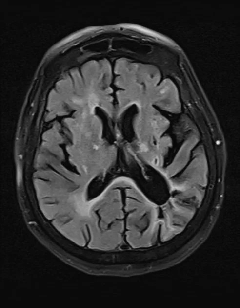 Understanding White Matter Disease: What Your MRI Report Means ...