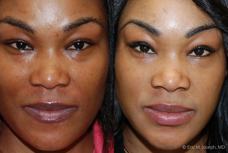 Eric M. Joseph, MD | Blepharoplasty Before & After: Congenital Lower ...