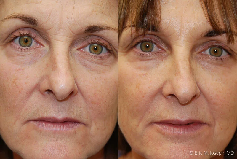 Eric M. Joseph, MD | Silikon-1000 Before & After: Softened Wrinkles ...