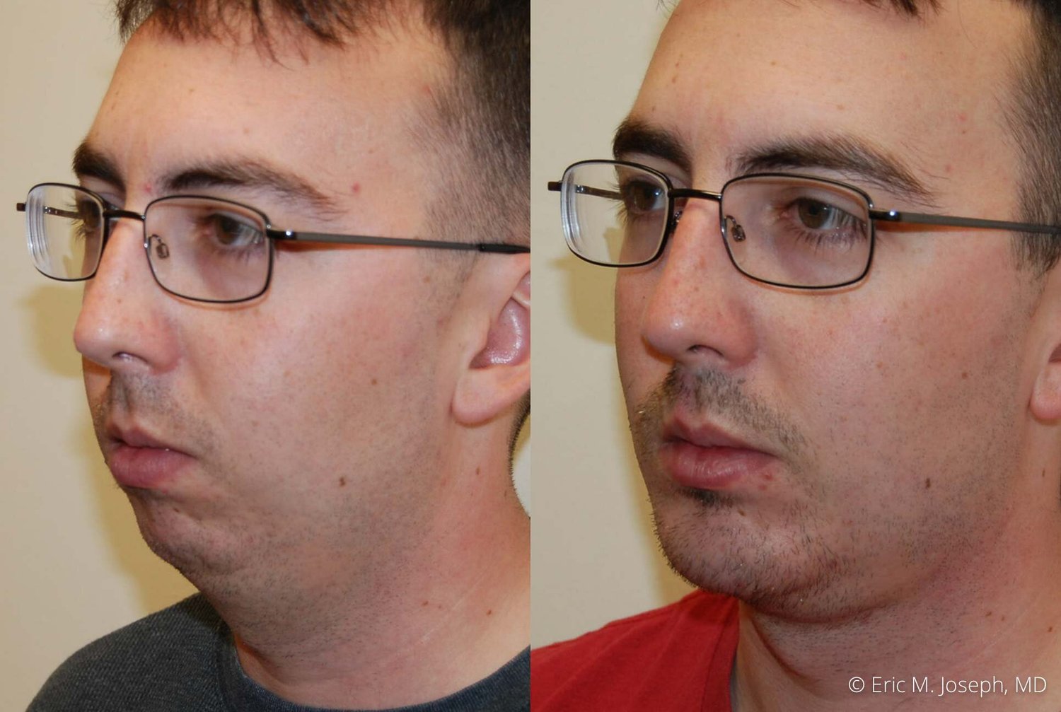 Eric M. Joseph, MD | Chin & Neck Before & After: Chin Implant with Neck ...