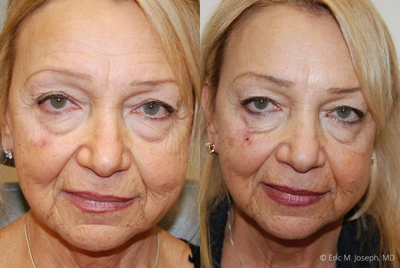 Botox Before And After Crows Feet