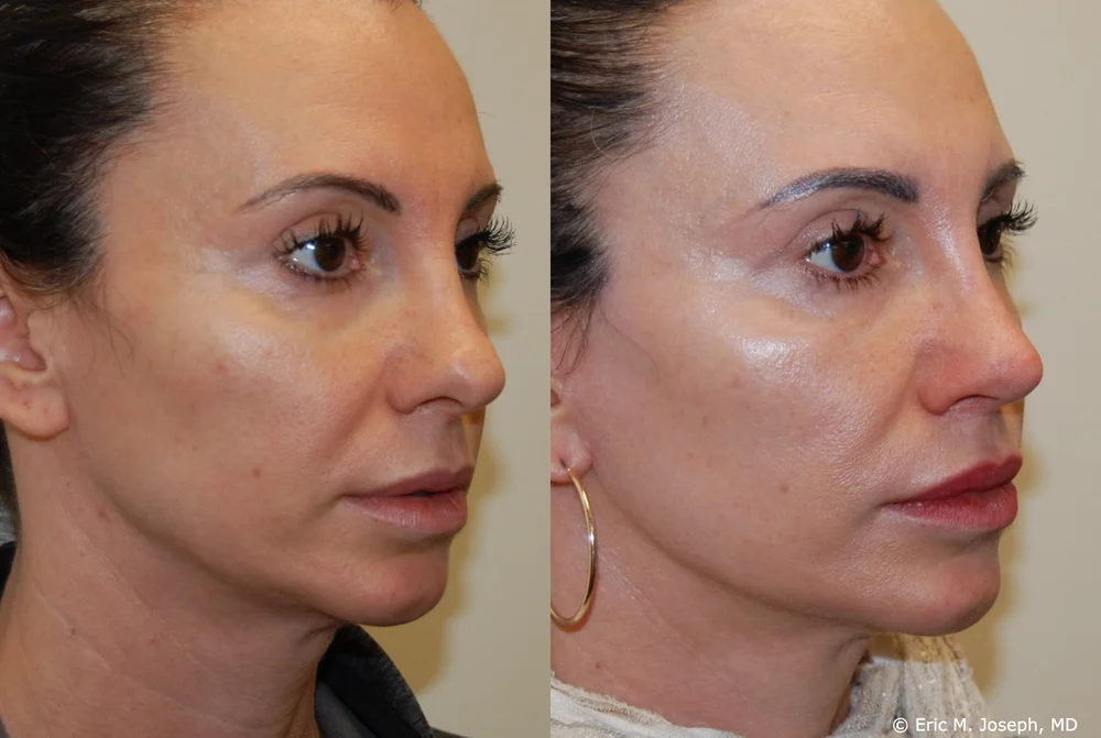 Eric M. Joseph, MD | Revision Rhinoplasty Before & After: Total Tip ...