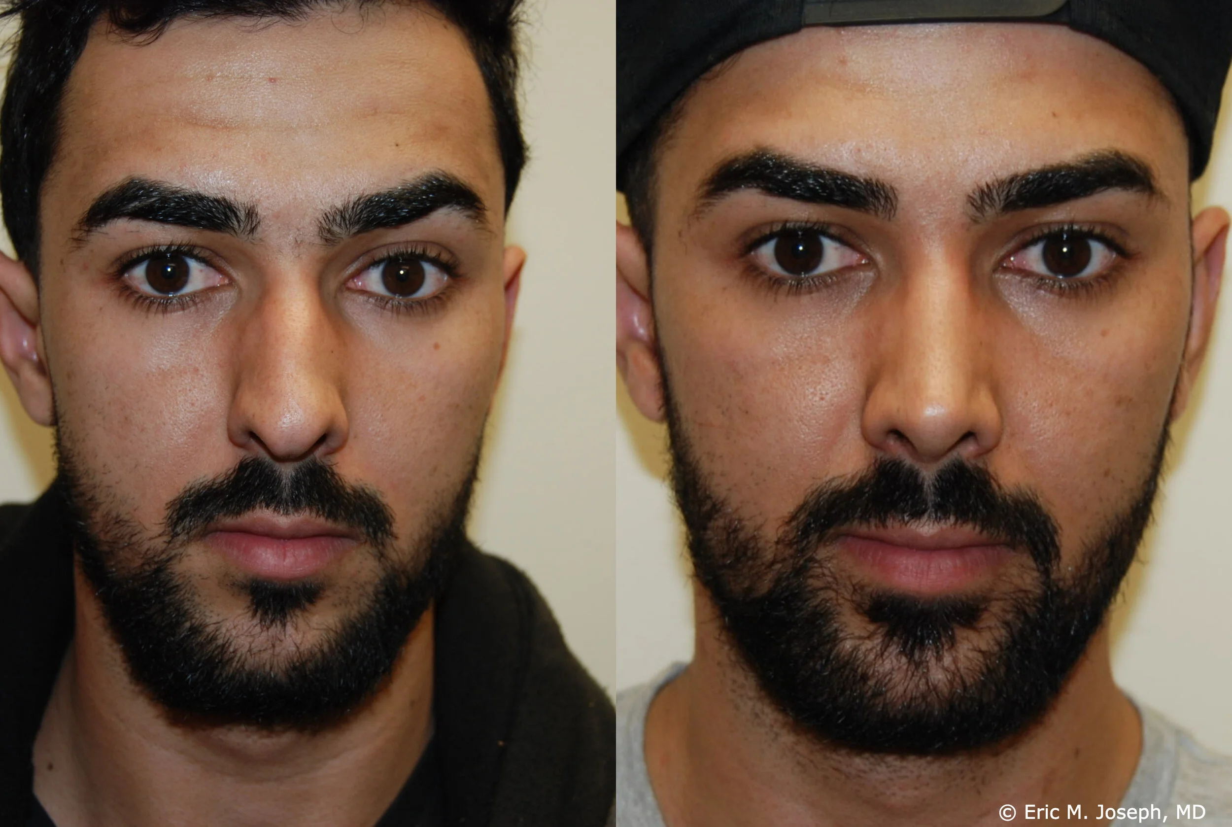 Eric M. Joseph, MD | Rhinoplasty Before & After: Dorsal Hump and Droopy ...
