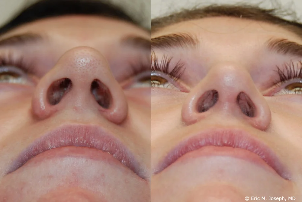 Eric M. Joseph, MD | Revision Rhinoplasty Before & After: Tip De ...