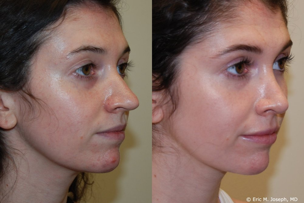 Eric M. Joseph, MD | Revision Rhinoplasty Before & After: Tip De ...