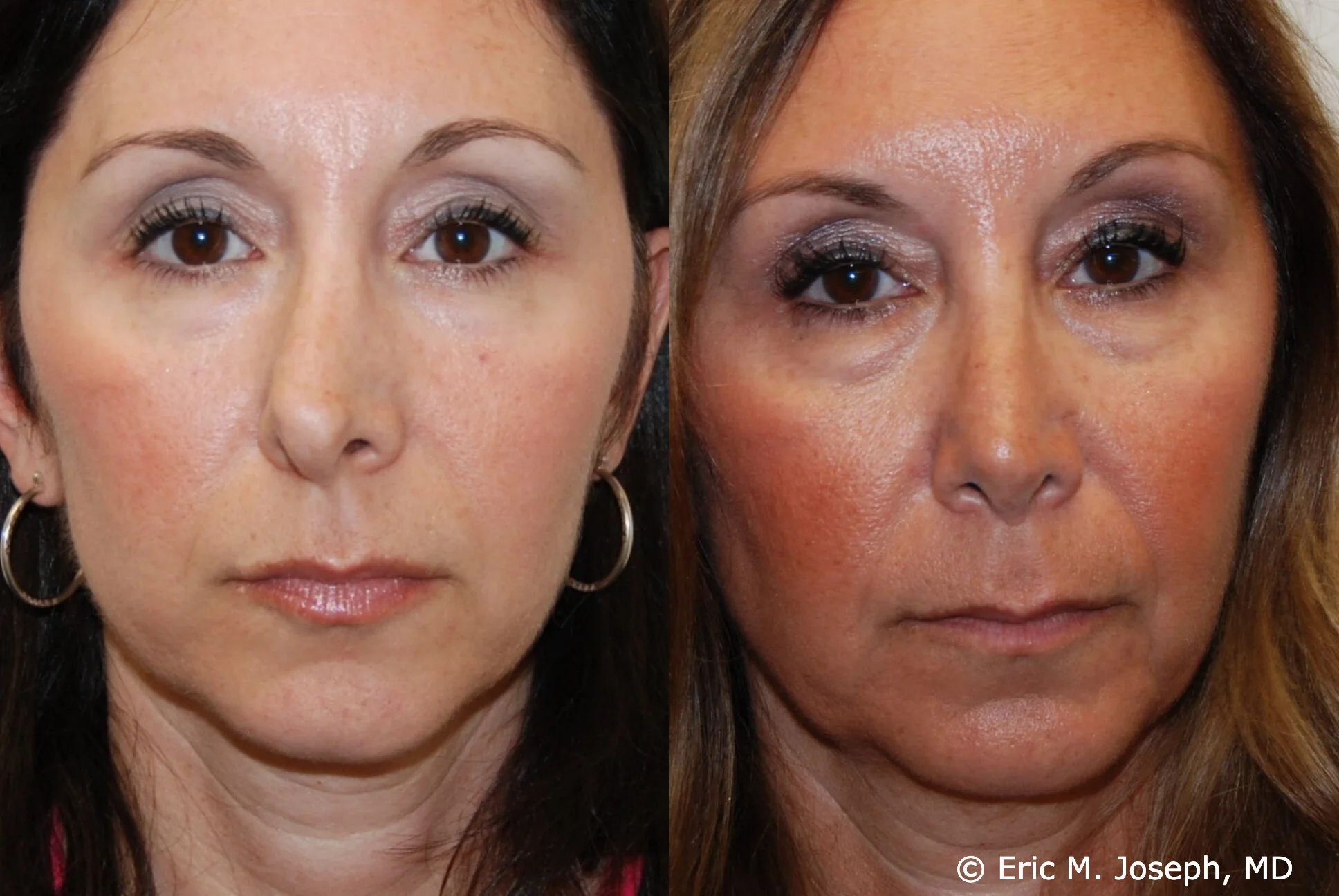 Eric M. Joseph, MD | Revision Rhinoplasty Before & After Photos