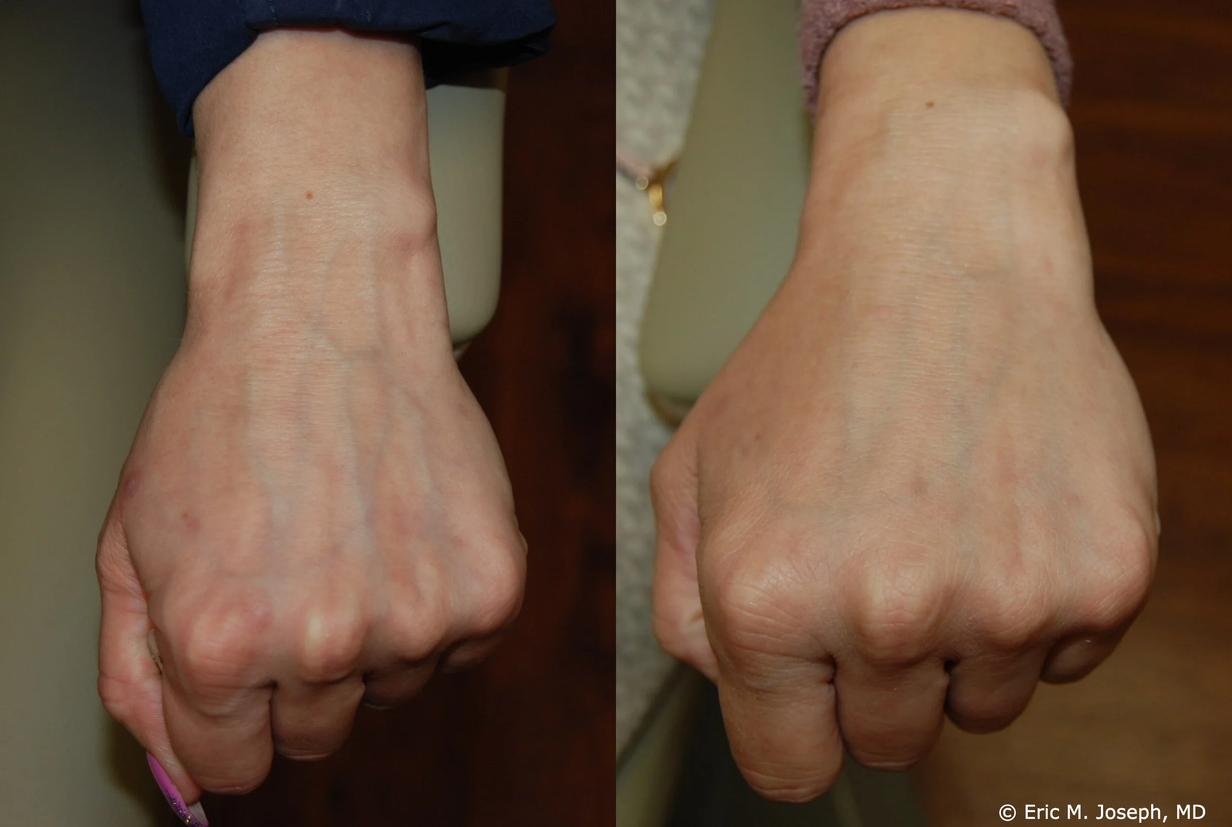 Eric M. Joseph, MD | Hand Rejuvenation